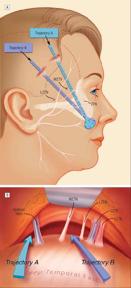 Entry Into The Midface A Vector Trajectories Of The Device Leash