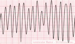 Ventricular Flutter ECGpedia