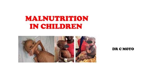 Severe Acute Malnutrition 1jtrfyuhtgguffhpdf Pdf