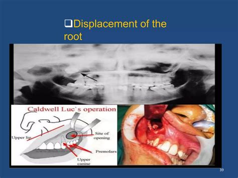 Complication Of Tooth Extraction Pptx