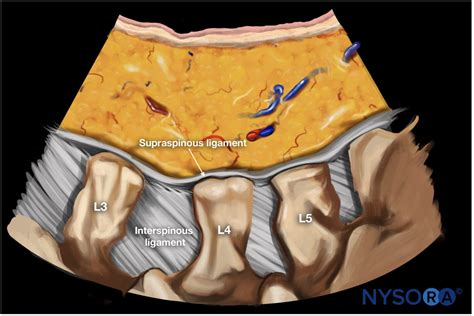 Ultrasound Guided Lumbar Facet Nerve Block And Intra Articular