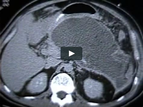 Laparoscopic Pancreatic Cyst Gastrostomy On Vimeo