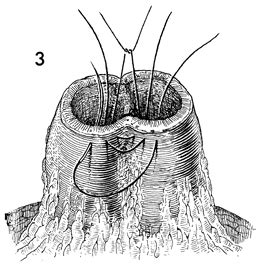Loop Ileostomy Closure