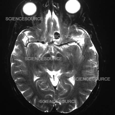 Ophthalmic Segment Aneurysm Mri Stock Image Science Source Images