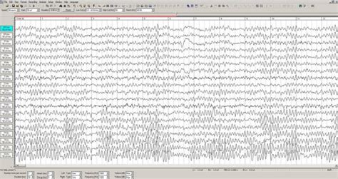 Quantitative Eeg Qeeg The Well Mind Center