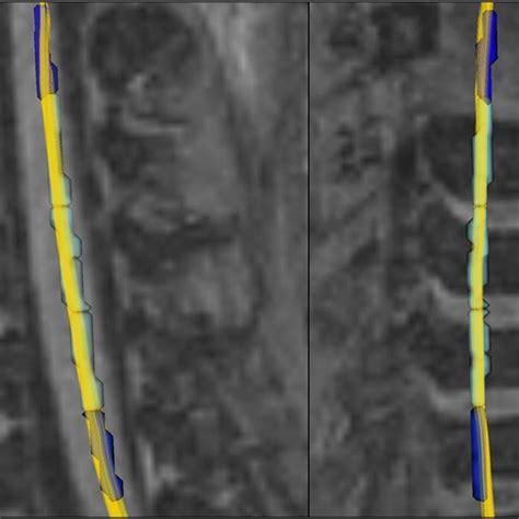 example of spinal cord tractography using labelled white matter