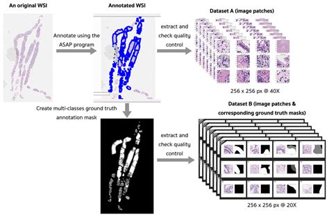 Binary Semantic Segmentation For Detection Of Prostate Adenocarcinoma Using An Ensemble With