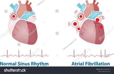 Normal Sinus Rhythm Vs Atrial Fibrillation Stock Vector Royalty Free 2237957421 Shutterstock