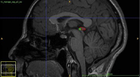 The Segmentation Of The Pineal Gland With Itk Snap Program Download