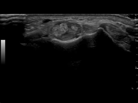 Extensor Compartment 4 Tenosynovitis Ultrasound Cases