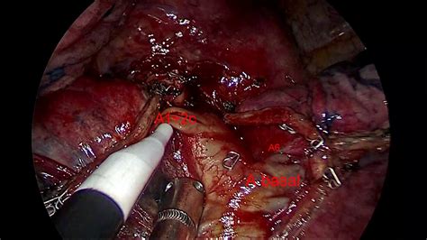 Uniportal Vats Left Upper Division Trisegmentectomy Ls1 3 Youtube