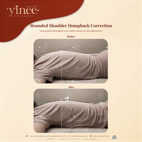 Yinee Rounded Shoulder Humpback Correction Hunchback Problem Has Improvement In Just 1