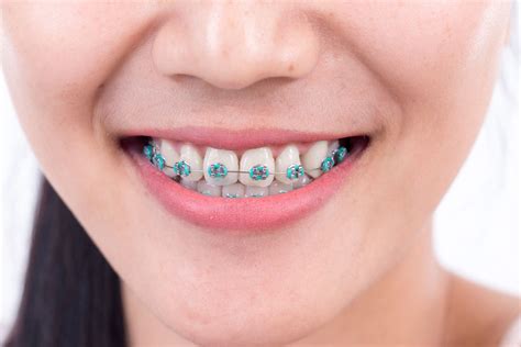 The Purposes Of Rubber Bands On Braces