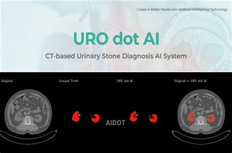 Бөөр шээсний замын чулуу илрүүлэх хиймэл оюун ухааны шийдэл “urodot Ai