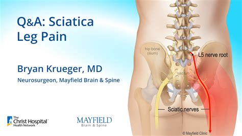 Sciatic Nerve Pain