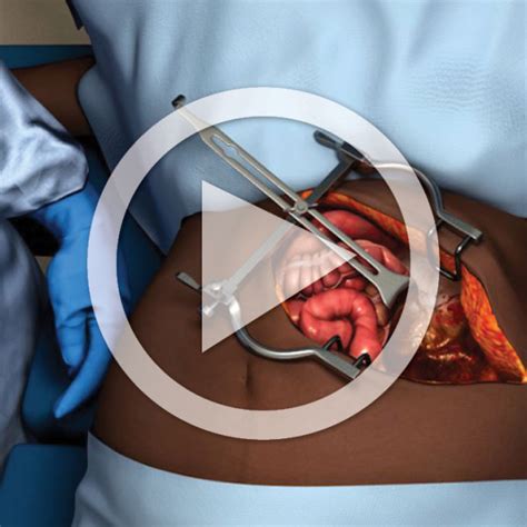 Medical Legal Exhibits Legal Animations And Trial Graphics