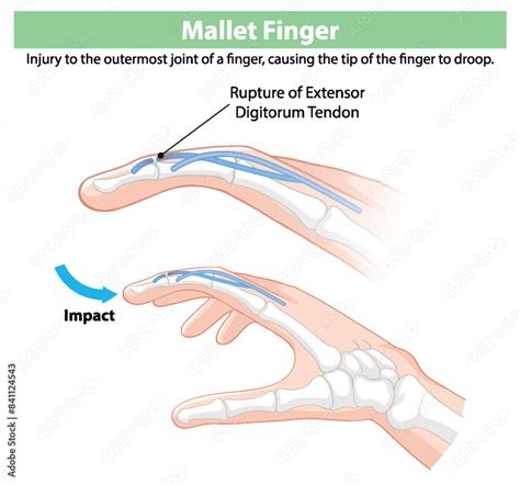 Depicts Rupture Of Extensor Digitorum Tendon Stock Vector Adobe Stock