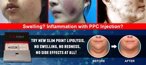 New Lipodissolve Solution Slim Point Lipolysis Injection Compares To