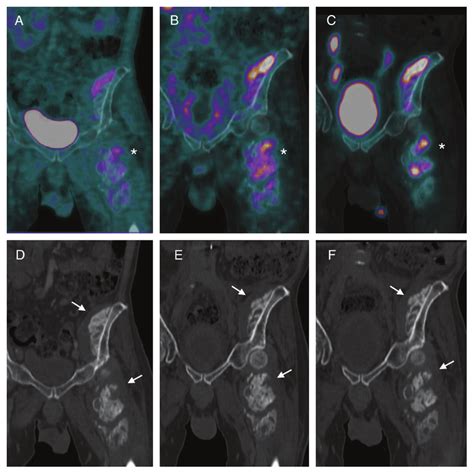 A Complementary 3 Phase Bone Scan Was Secondly Performed The Bone Scan Download Scientific