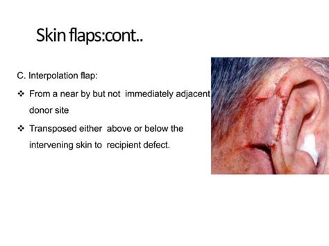 Flaps And Its Classification Pptx