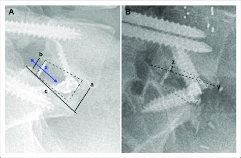 A Demonstrates Measurements Of Anterior Disc Height A Posterior