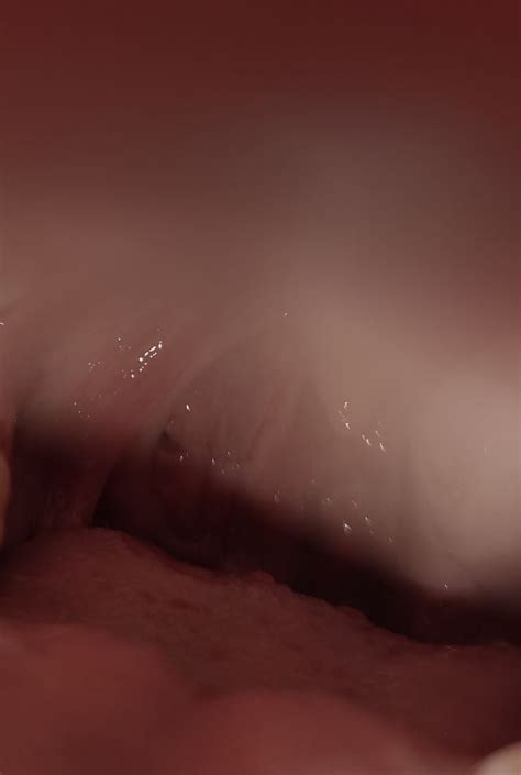 Tonsil Crypts And Stones Are Ruining My Life Rtonsilstones