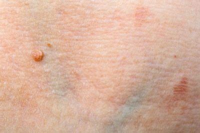 What Does Hpv Look Like Symptoms And What To Do 49 Off