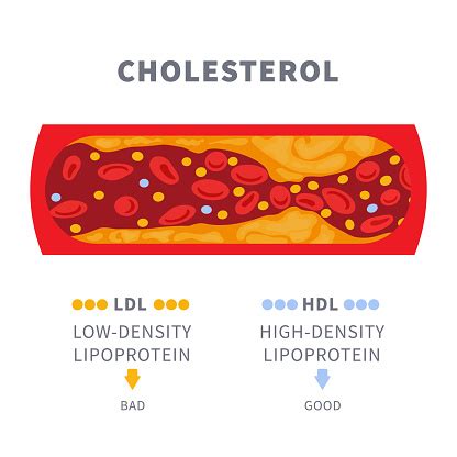 Cholesterol Plaque Buildup In Blocked Artery Diagram Stock Illustration Download Image Now