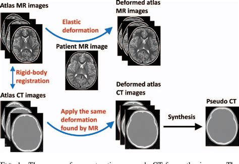 Figure 1 From Mri Based Treatment Planning With Pseudo Ct Generated