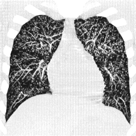 Tree In Bud Pattern Ajr