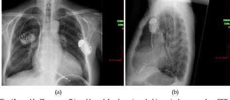 Biventricular Pacemaker Chest X Ray