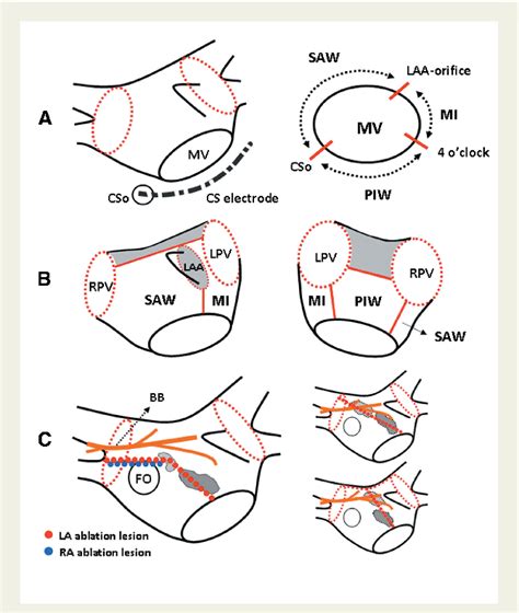 Figure 1 From Peri Mitral Atrial Flutter Personalized Ablation Strategy Based On Arrhythmogenic Figure 1 From Peri Mitral Atrial Flutter Personalized Ablation Strategy Based On Arrhythmogenic