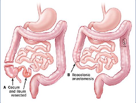 A Resection Of The Cecum And Ileum B With Ileocolonic Anastomosis Download Scientific Diagram