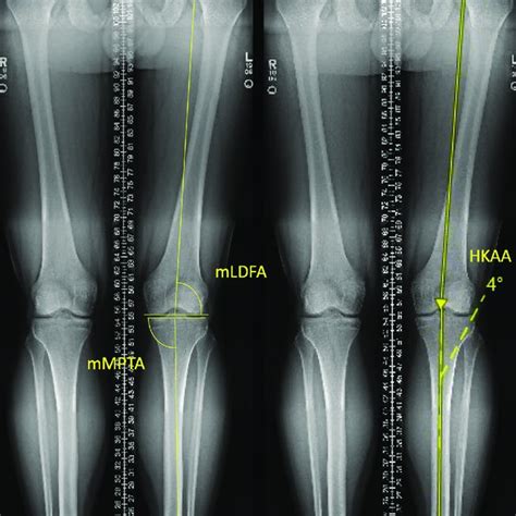 Pdf Technique For Biplanar Lateral Opening Wedge Distal Femoral