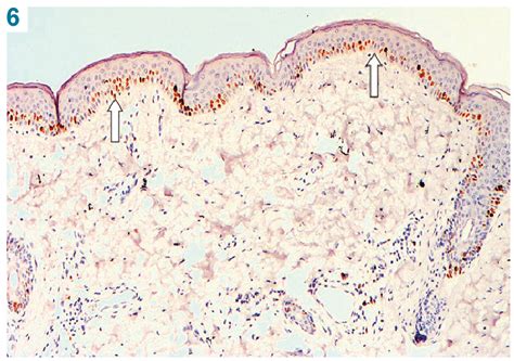 Keratoderma Signs Of Severe Hyperkeratosis Of The Integumentary Download Scientific Diagram
