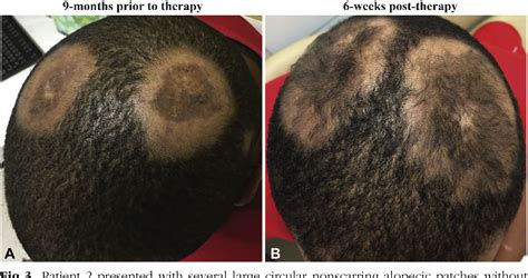 Figure 1 From An Atypical Clinical Presentation Of Alopecia In 2 Patients With Systemic Lupus