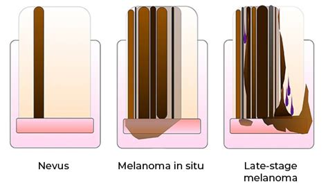Nail Melanoma Symptoms Photos Stages