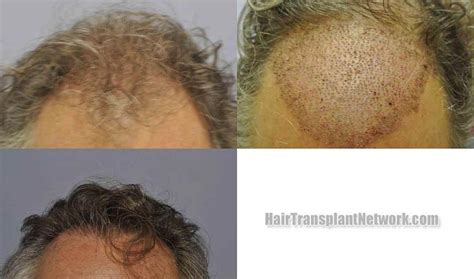 Dr William Lindsey Hair Transplant Surgical Procedure Before And After