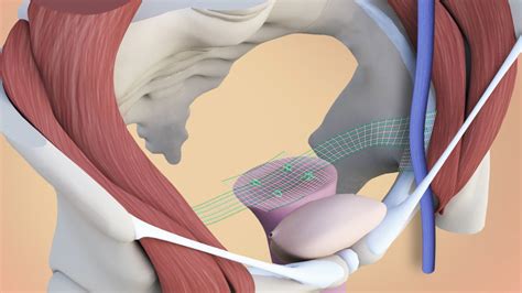 Simulaciones Cirugía Pélvica Artline