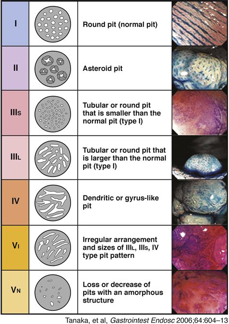 Endoscopic Recognition And Management Strategies For Malignant Colorectal Polyps Endoscopic Recognition And Management Strategies For Malignant Colorectal Polyps
