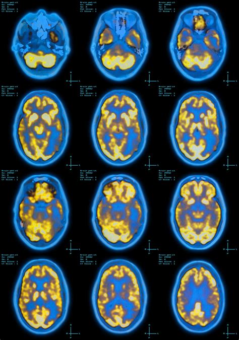 Map Shows Brain Changes Linked To Mental Illness