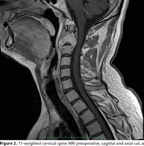 Cervical Spine Mri Tumor