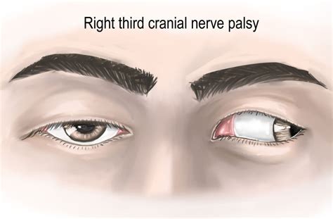 Third Nerve Palsy Causes Symptoms And Treatment Third Nerve Palsy Causes Symptoms And Treatment