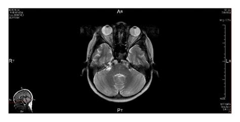 Mri Findings Of The Patient With Follicular Lymphoma Mri Image Shows