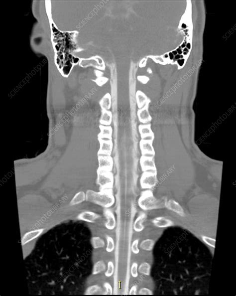Cervical Myelogram Ct Stock Image C027 1643 Science Photo Library
