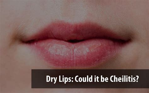 Dry Red Lips Red Around The Lips Diamondjack Jewelry