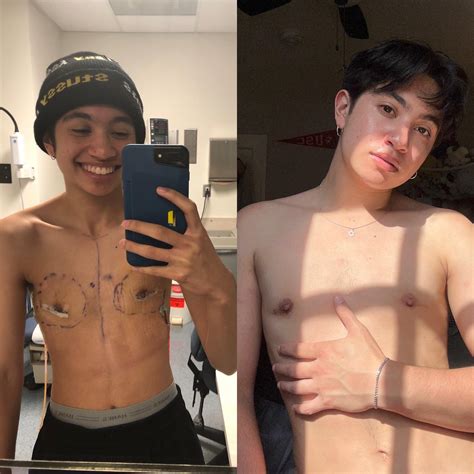 4 Years Post Op Top Surgery R Ftm