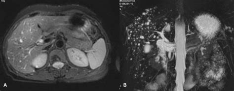 Biliary Hamartomas Multiple Variable Sized Small Cystic Lesions Download Scientific Diagram