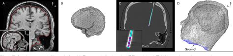 figure 1 from creating and parameterizing patient specific deep brain