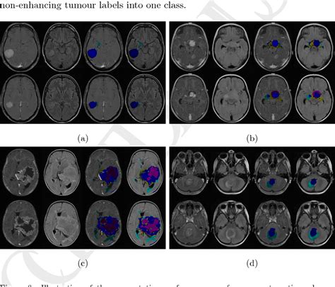 Figure 6 From Machine Learning Based Brain Tumour Segmentation On
